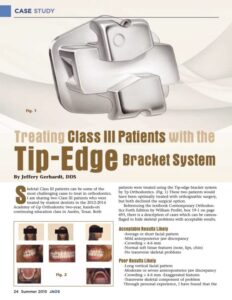 Treating Class III Patients With The Tip-Edge Bracket System ...