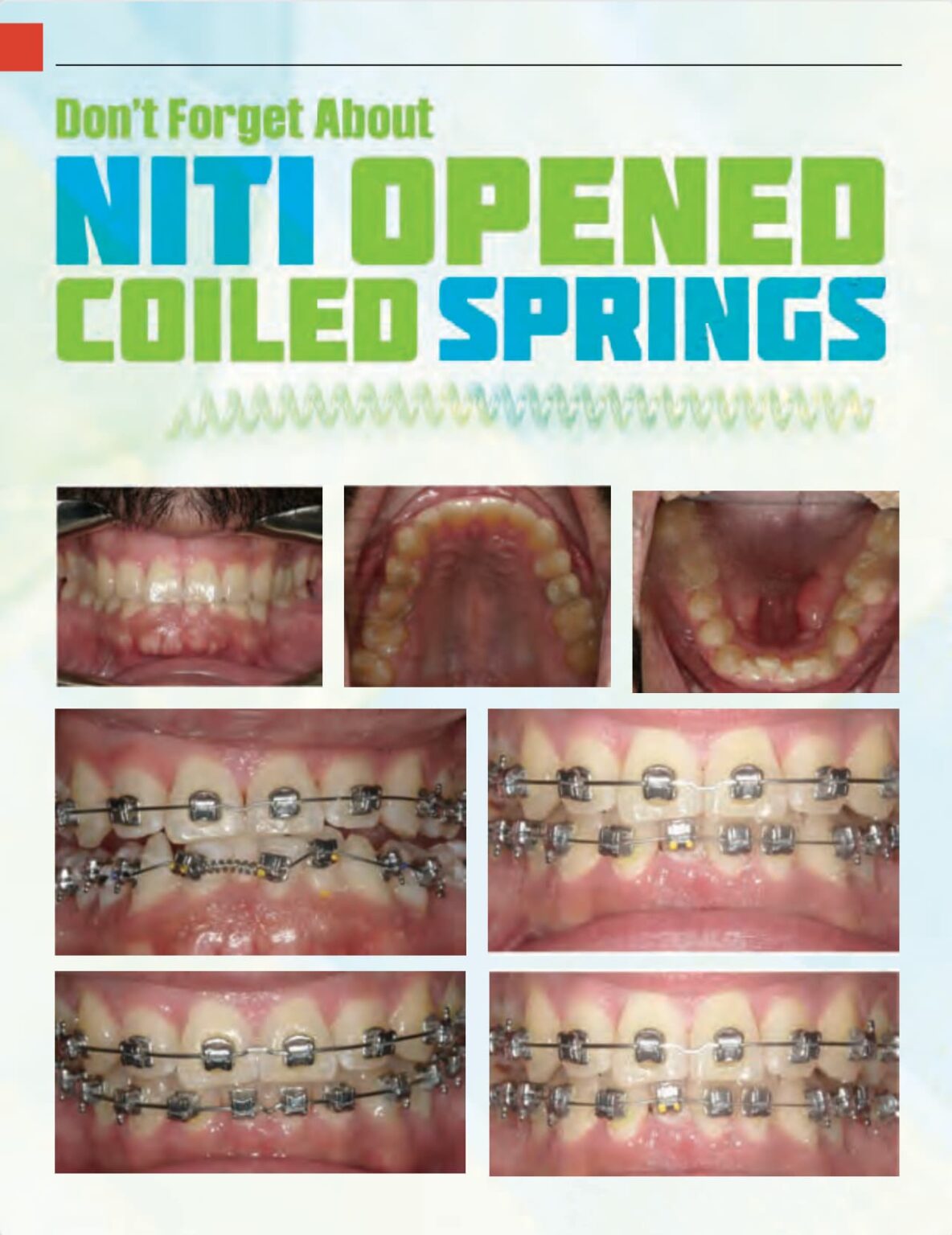 Don’t Forget About Niti Opened Coiled Springs | Orthodontics for ...
